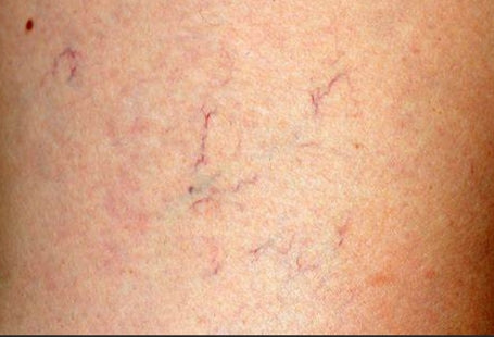 Vascular (Spider Veins) – Vita Beauty Bar